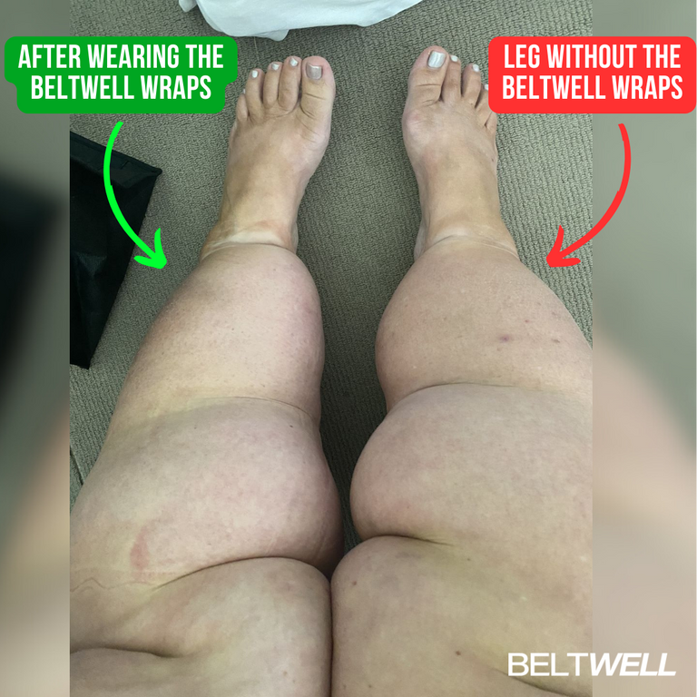Beltwell® - The Full-Leg Compression Wrap System