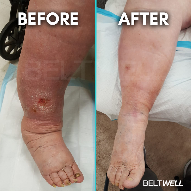 Beltwell® - The Full-Leg Compression Wrap System